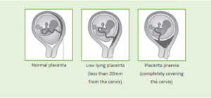 Placenta Previa During Pregnancy: Facts You Need To Know